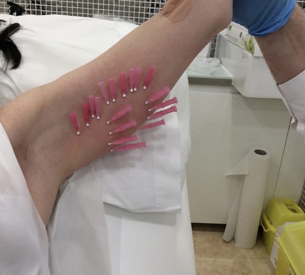 PDO Body Thread Lift Advanced Training Course - Harley Elite Academy